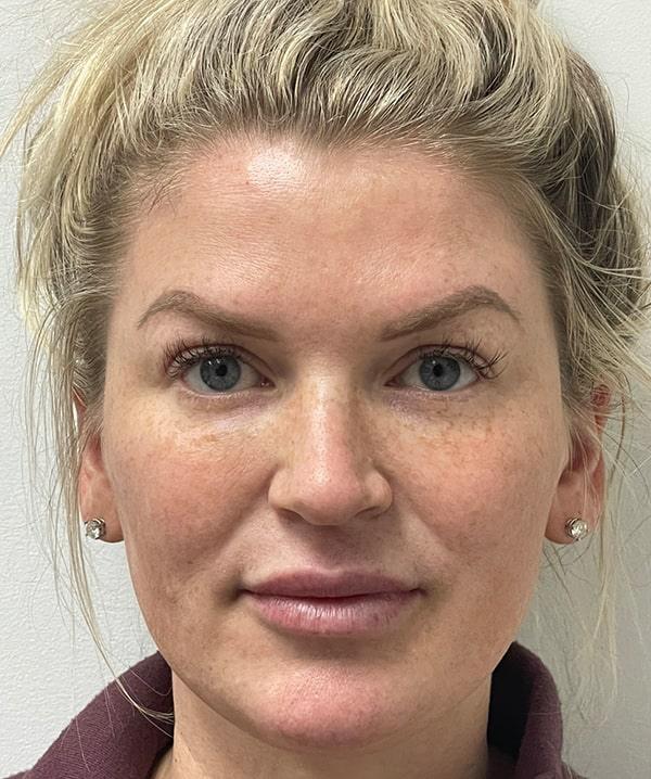 J Lift™ Instant Facelift Near Me in Orlando, FL | 30 Minutes Facelift ...